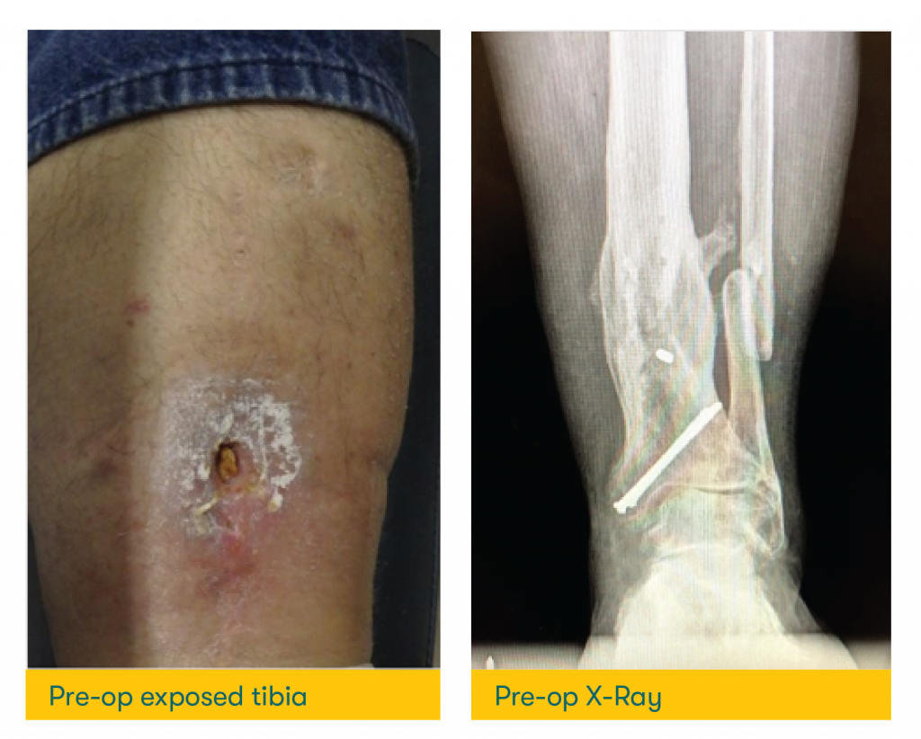 Wound Healing Awareness Month | BioTissue