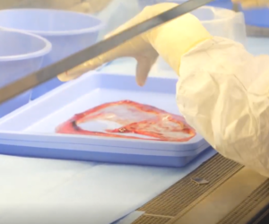 Clarix 100 Amniotic Graft for Podiatric Surgery | BioTissue